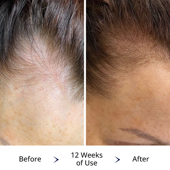 3 in 1 Scalp Pro Derma Roller 540 Titanium microneedles | For Hair Gro